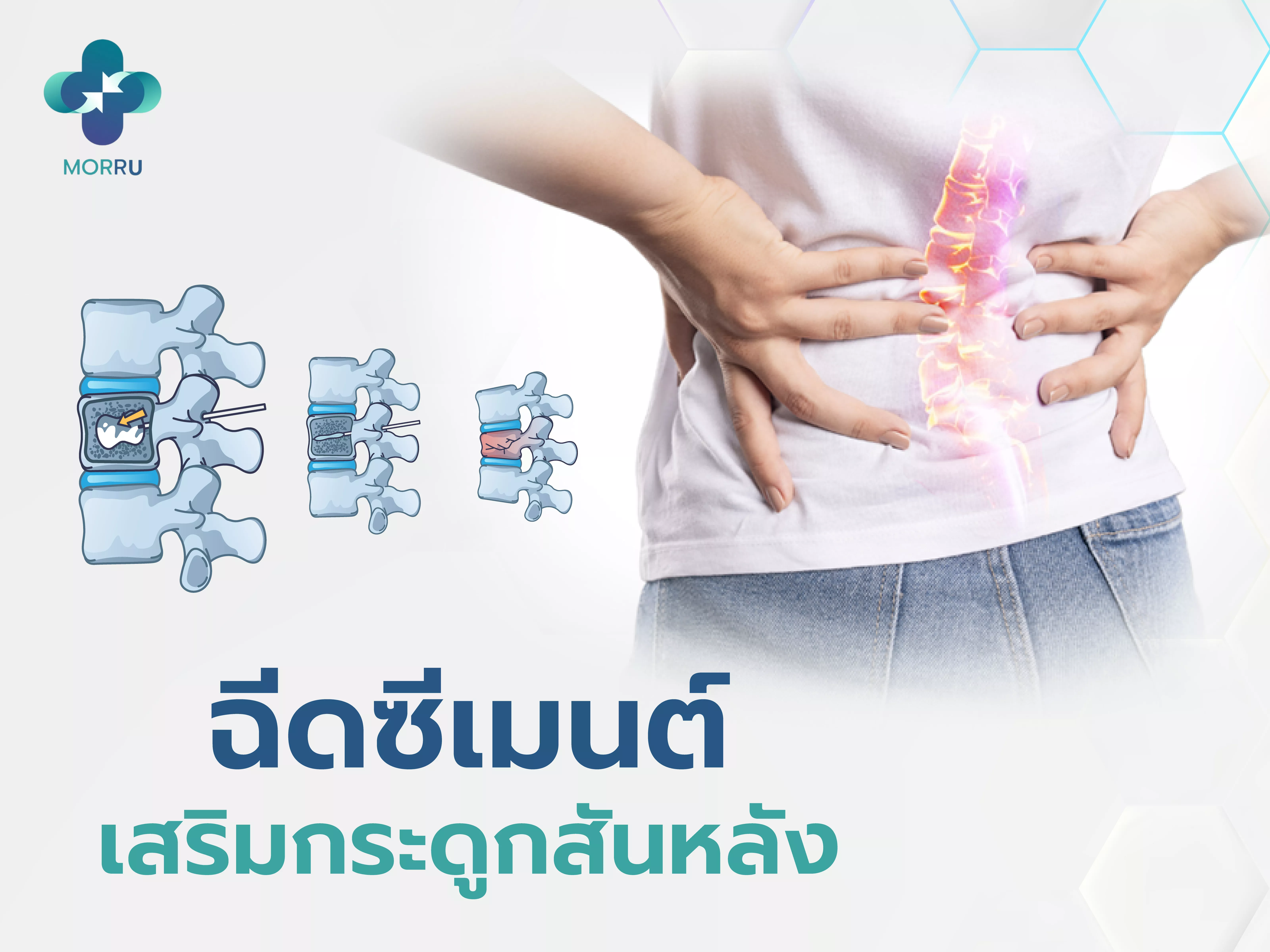 การฉีดซีเมนต์เสริมกระดูก | MORRU