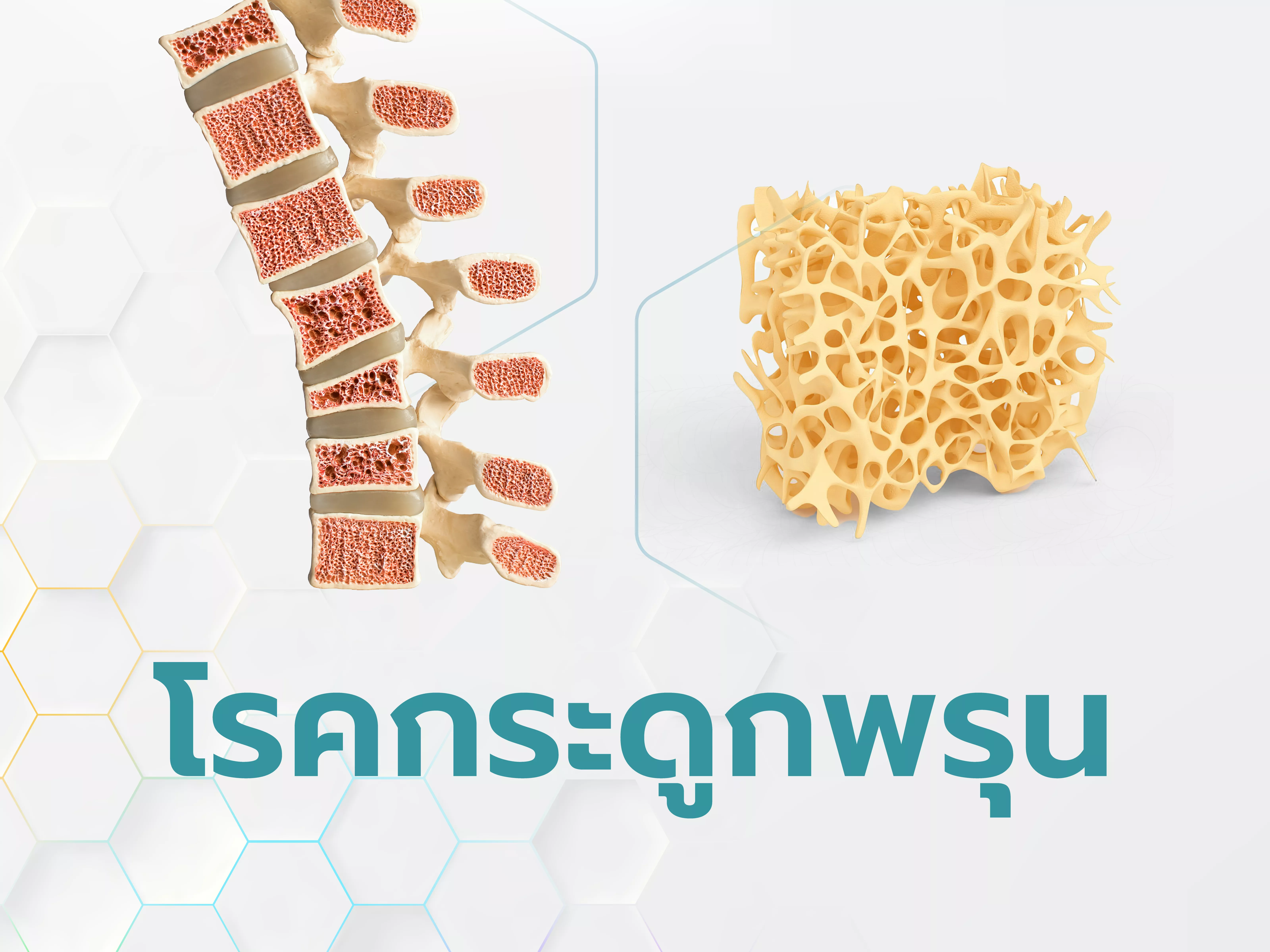 โรคกระดูกพรุน | MORRU